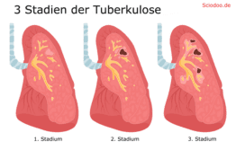 Die 3 Stadien der Tuberkulose: Symptome und Krankheitsverlauf
